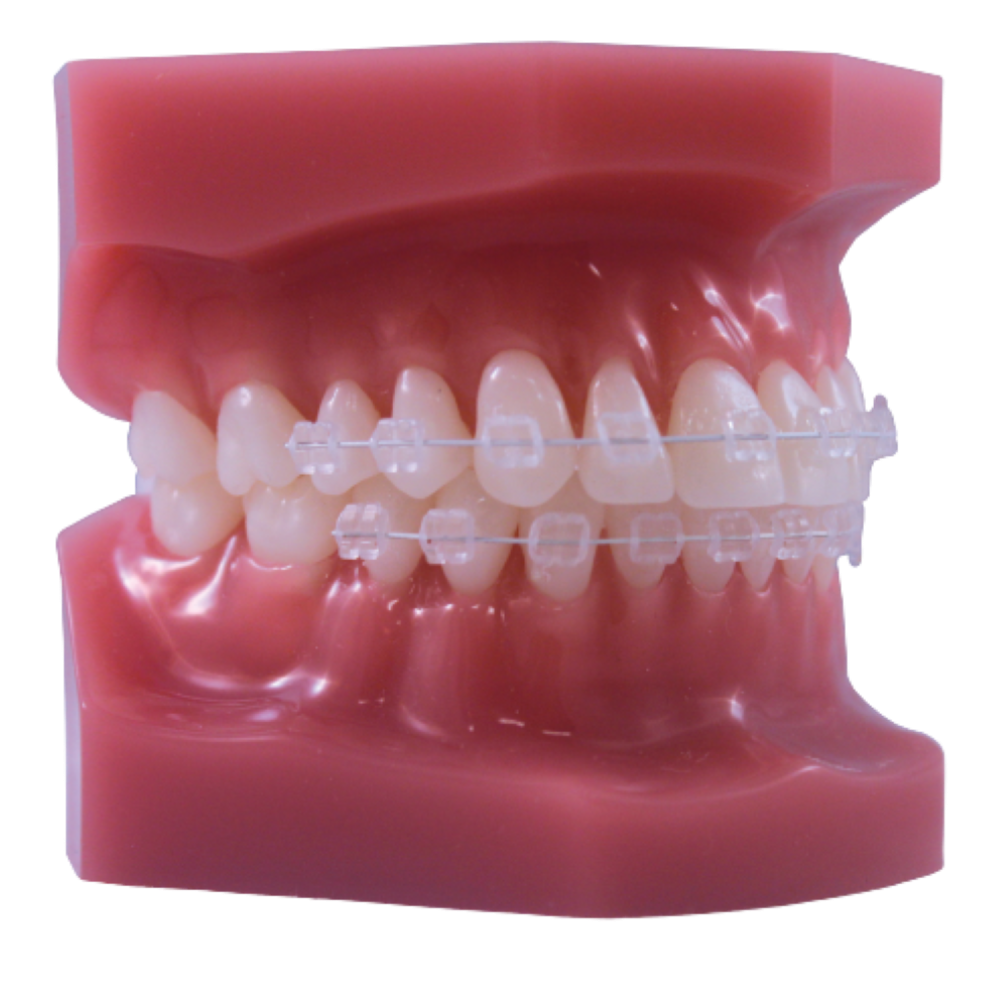 Avair Aesthetic Bracket, MBT, .022 (case) - Young Specialties