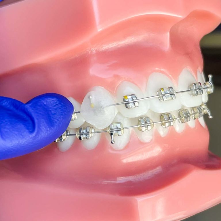 Plak Smacker Relief Wax - No Flavor (144 ct) - Young Specialties