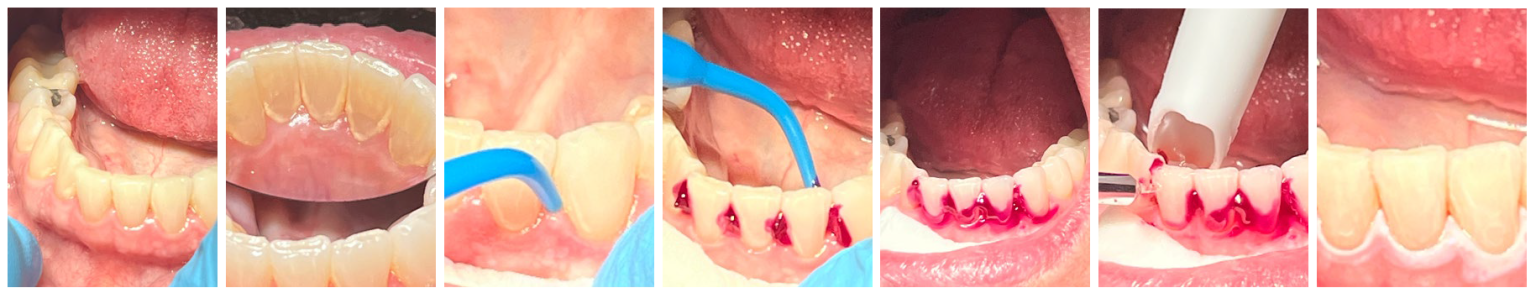 PerioDT Biofilm Debridement Sulfonated Phenolics - Young Specialties